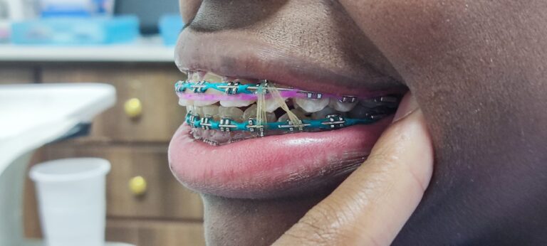 How Much Do Braces Cost in Nairobi, Kenya?